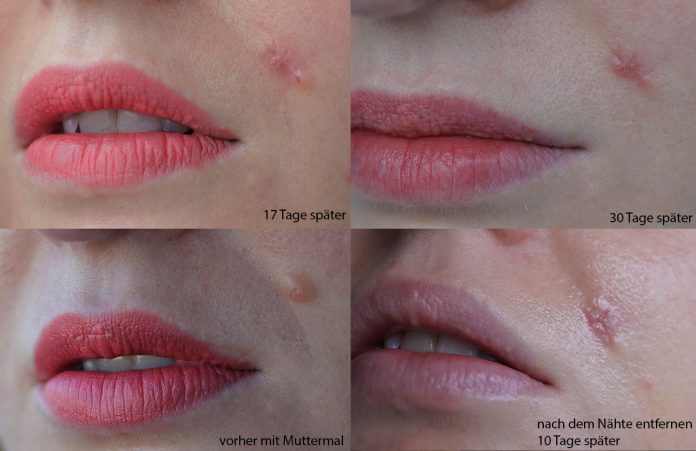 Muttermal Entfernung im Gesicht - Meine Erfahrung bei The Aesthetics ...